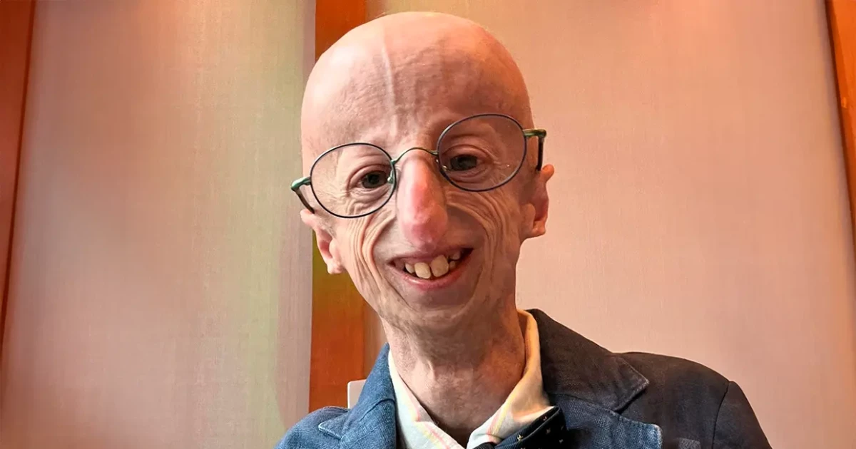 Adiós a Sammy, el paciente con progeria más longevo del mundo